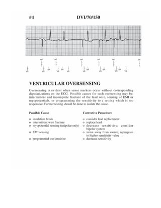 ECG tracing in pacemaker patients | PDF