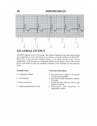 ECG tracing in pacemaker patients | PDF