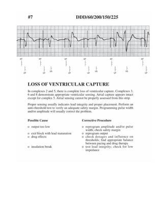 ECG tracing in pacemaker patients | PDF