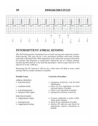 ECG tracing in pacemaker patients | PDF