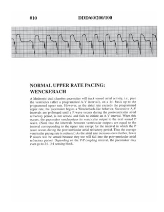 ECG tracing in pacemaker patients | PDF