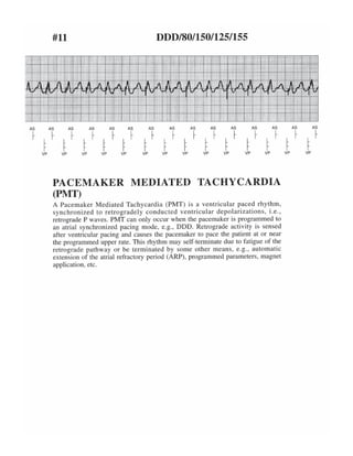 ECG tracing in pacemaker patients | PDF