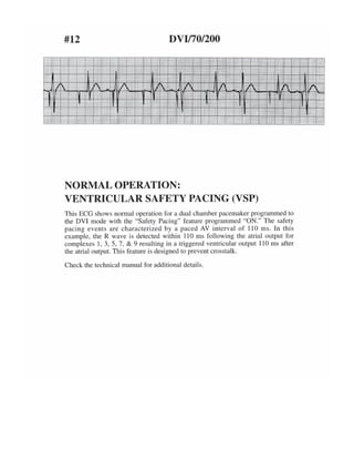 ECG tracing in pacemaker patients | PDF