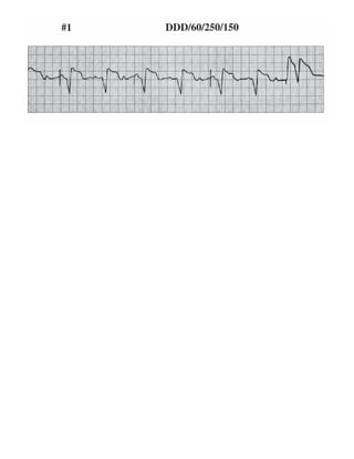 ECG tracing in pacemaker patients | PDF