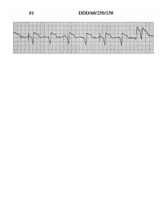 ECG tracing in pacemaker patients | PDF | Heart and Cardiovascular ...