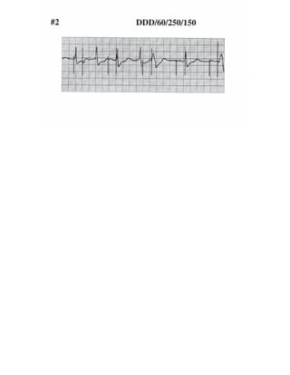 ECG tracing in pacemaker patients | PDF