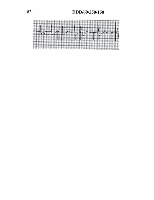 ECG tracing in pacemaker patients | PDF | Heart and Cardiovascular ...