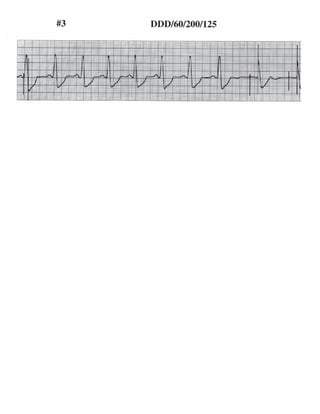 ECG tracing in pacemaker patients | PDF