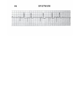 ECG tracing in pacemaker patients | PDF