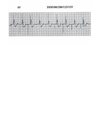 ECG tracing in pacemaker patients | PDF