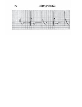 ECG tracing in pacemaker patients | PDF