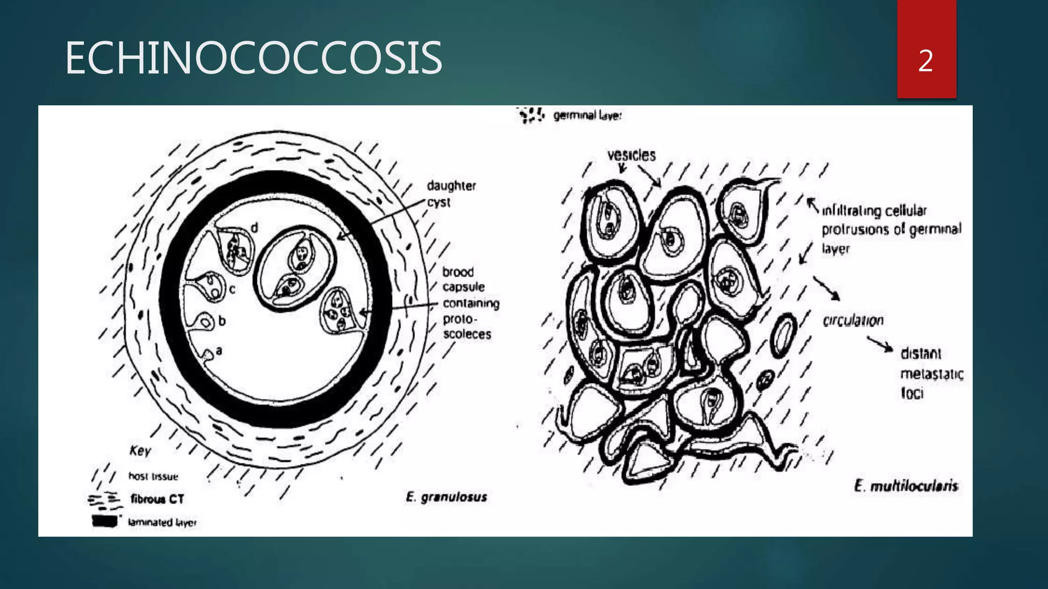 Echinococcosis, signs and symptoms, diagnosis and management. | PPTX