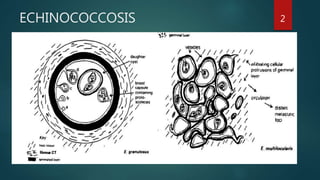 Echinococcosis, signs and symptoms, diagnosis and management. | PPTX