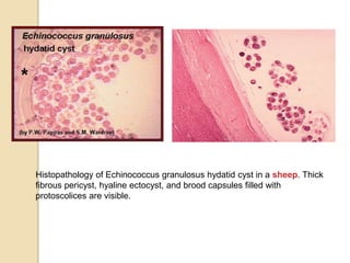 Echinococcus Granulosus Slide