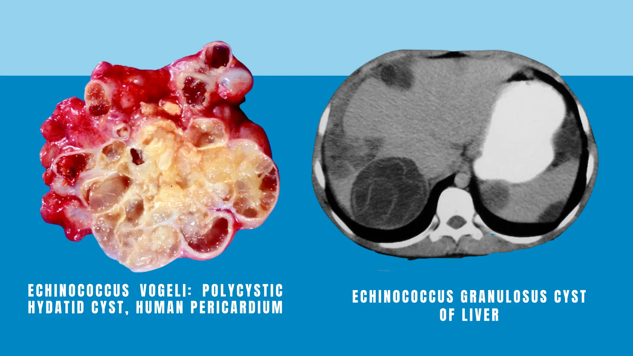 ECHINOCOCCUS GRANULOSUS.pdf