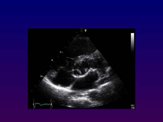 Echo.basics | PPT | Heart and Cardiovascular Diseases | Diseases and ...