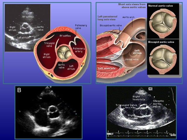 Echo.basics | PPT | Heart and Cardiovascular Diseases | Diseases and ...