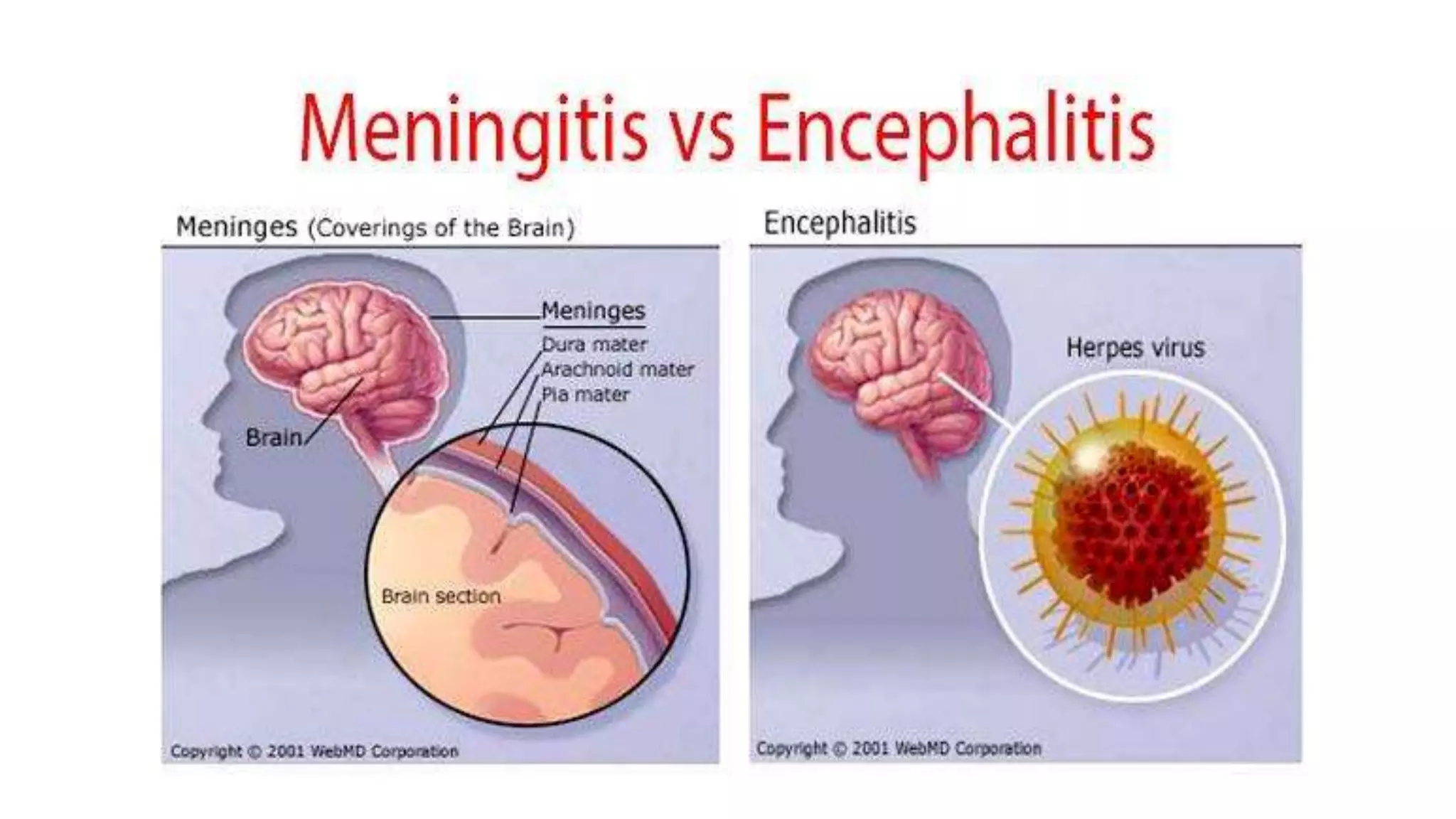 Meningitis: Viral Meningitis - Echovirus | PPTX