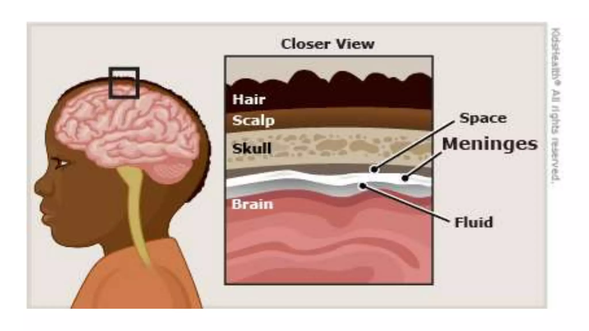Meningitis: Viral Meningitis - Echovirus | PPTX