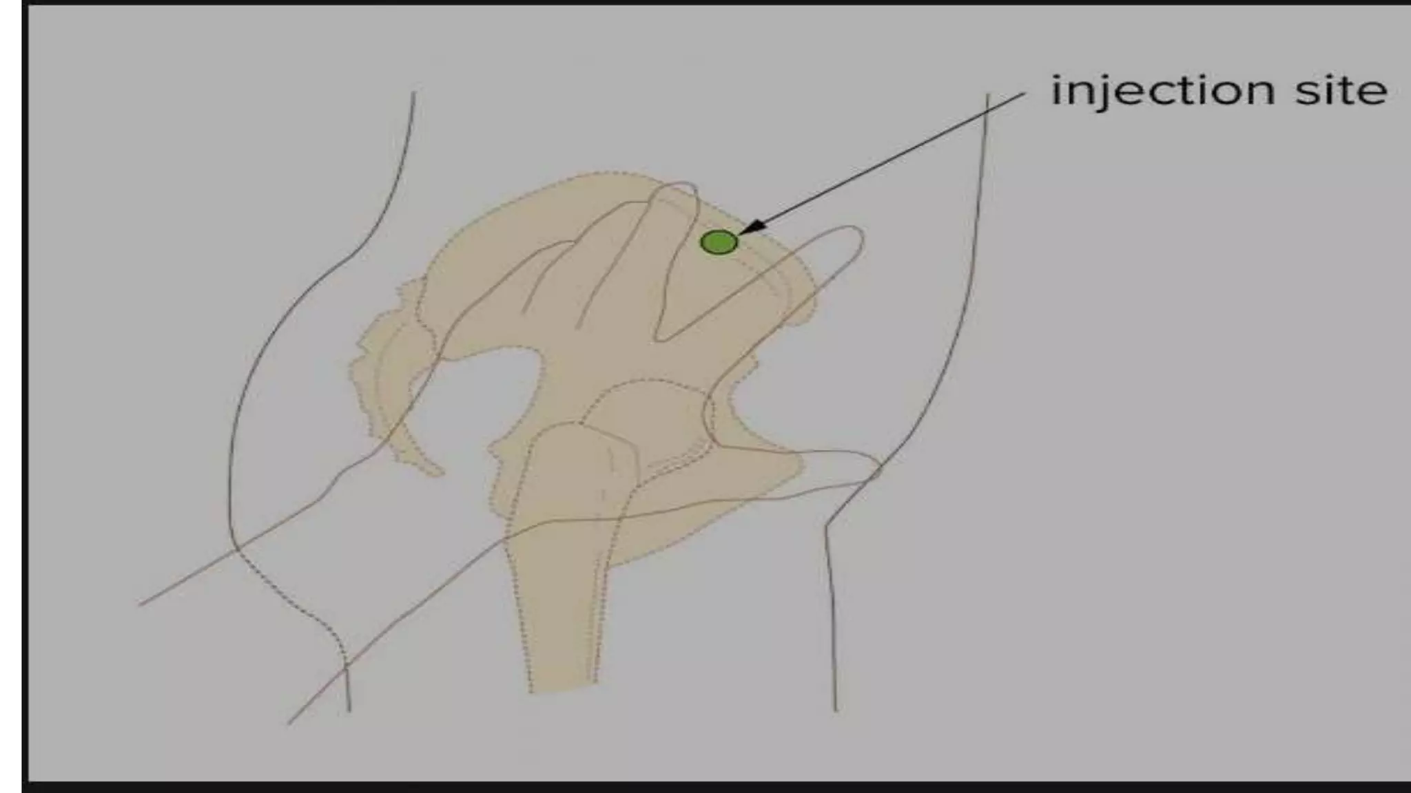 Echocardiography, CSF study, IV and IM injections | PPTX | Heart and ...