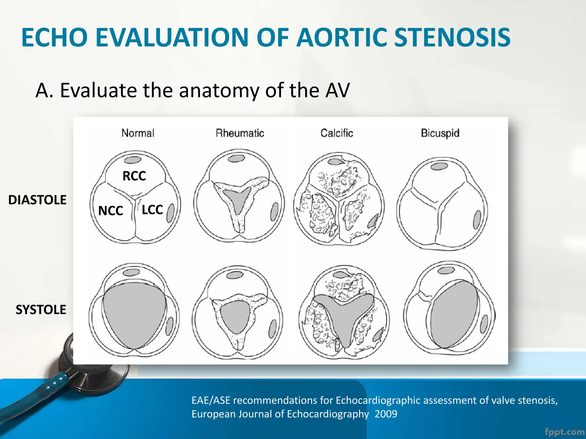Echo-Evaluation-of-Valvular-Stenosis-Cundangan.pdf