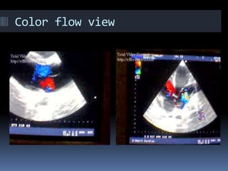 Echocardiogram - Basics | PPT