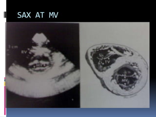 Echocardiogram - Basics | PPTX