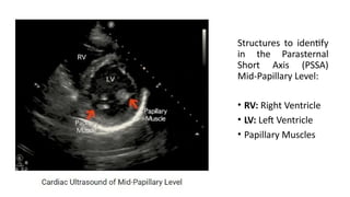 NORMAL ECHOCARDIOGRAPHIC ANATOMY OF THE HEART | PPTX
