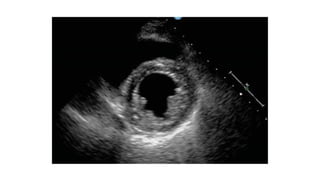 NORMAL ECHOCARDIOGRAPHIC ANATOMY OF THE HEART | PPTX