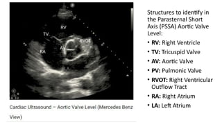 NORMAL ECHOCARDIOGRAPHIC ANATOMY OF THE HEART | PPTX