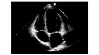 NORMAL ECHOCARDIOGRAPHIC ANATOMY OF THE HEART | PPTX
