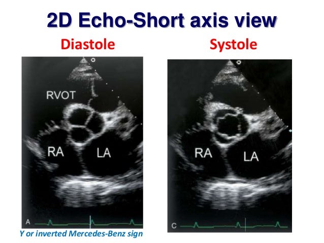 Echo assesment of as and ar