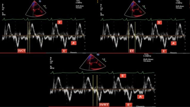 Echo assesment of rv function