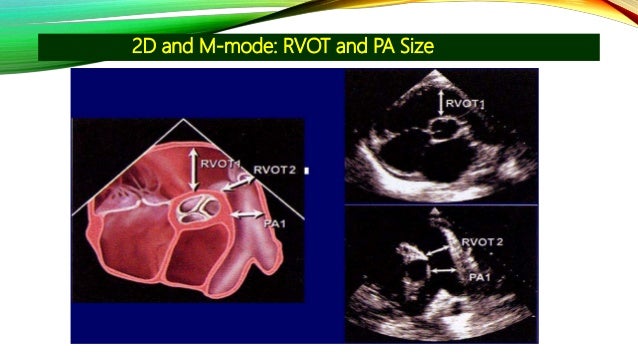 Echo assesmentof rv function