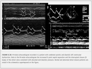 Echocardiographic assesment of systolic and diastolic dysfunction | PPTX
