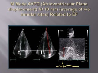 Echocardiographic assesment of systolic and diastolic dysfunction | PPTX