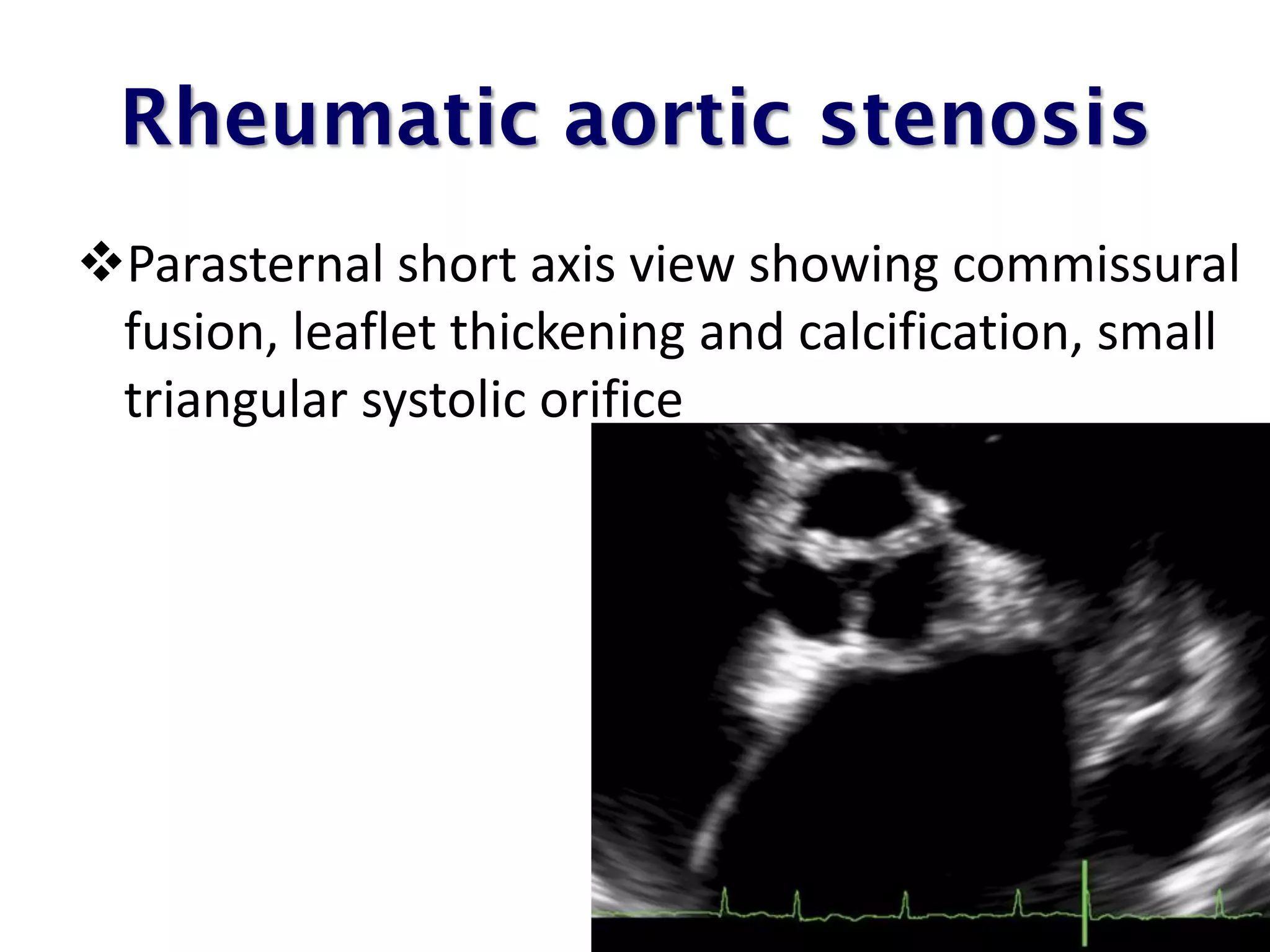 Echo assessment of aortic stenosis | PDF