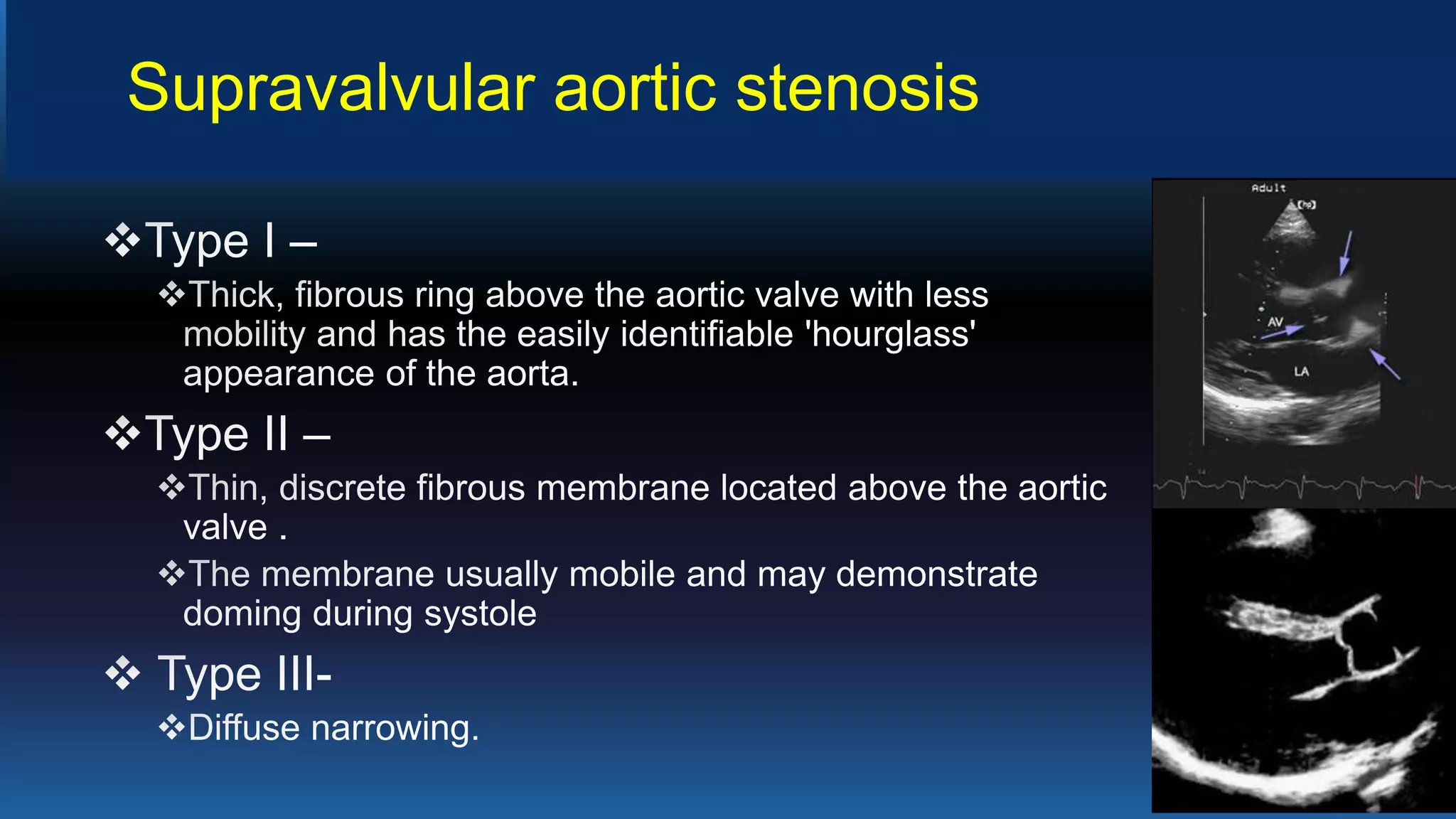 Echo assessment of aortic valve disease | PDF