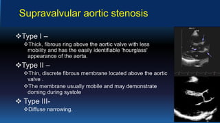 Aortic Valve Echo