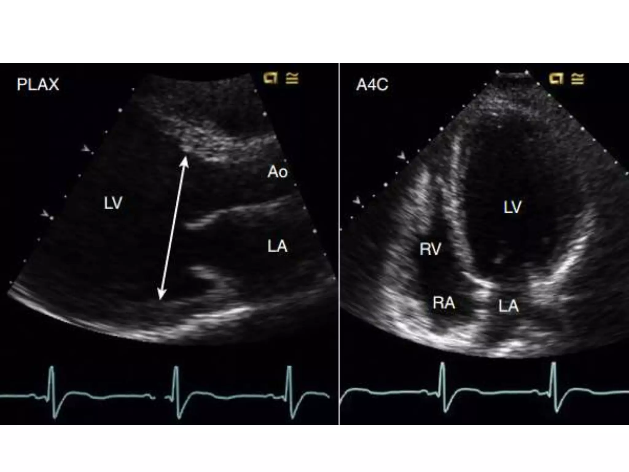 Echo assessment of Aortic Regurgitation | PPTX