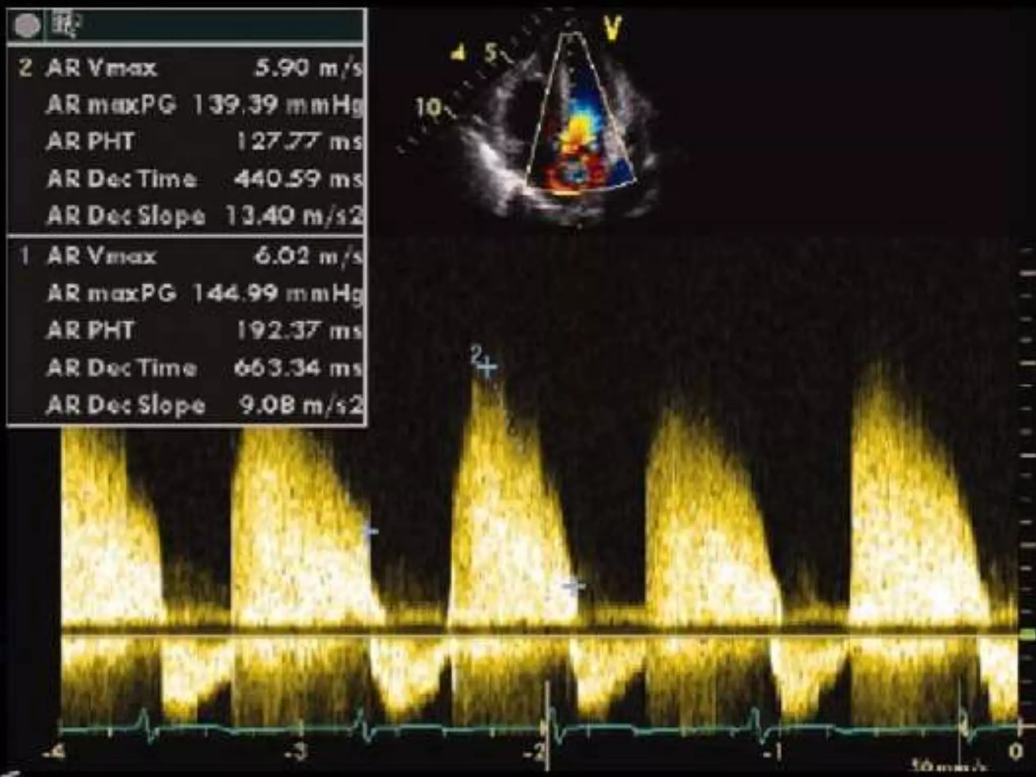 Echo assessment of Aortic Regurgitation | PPTX