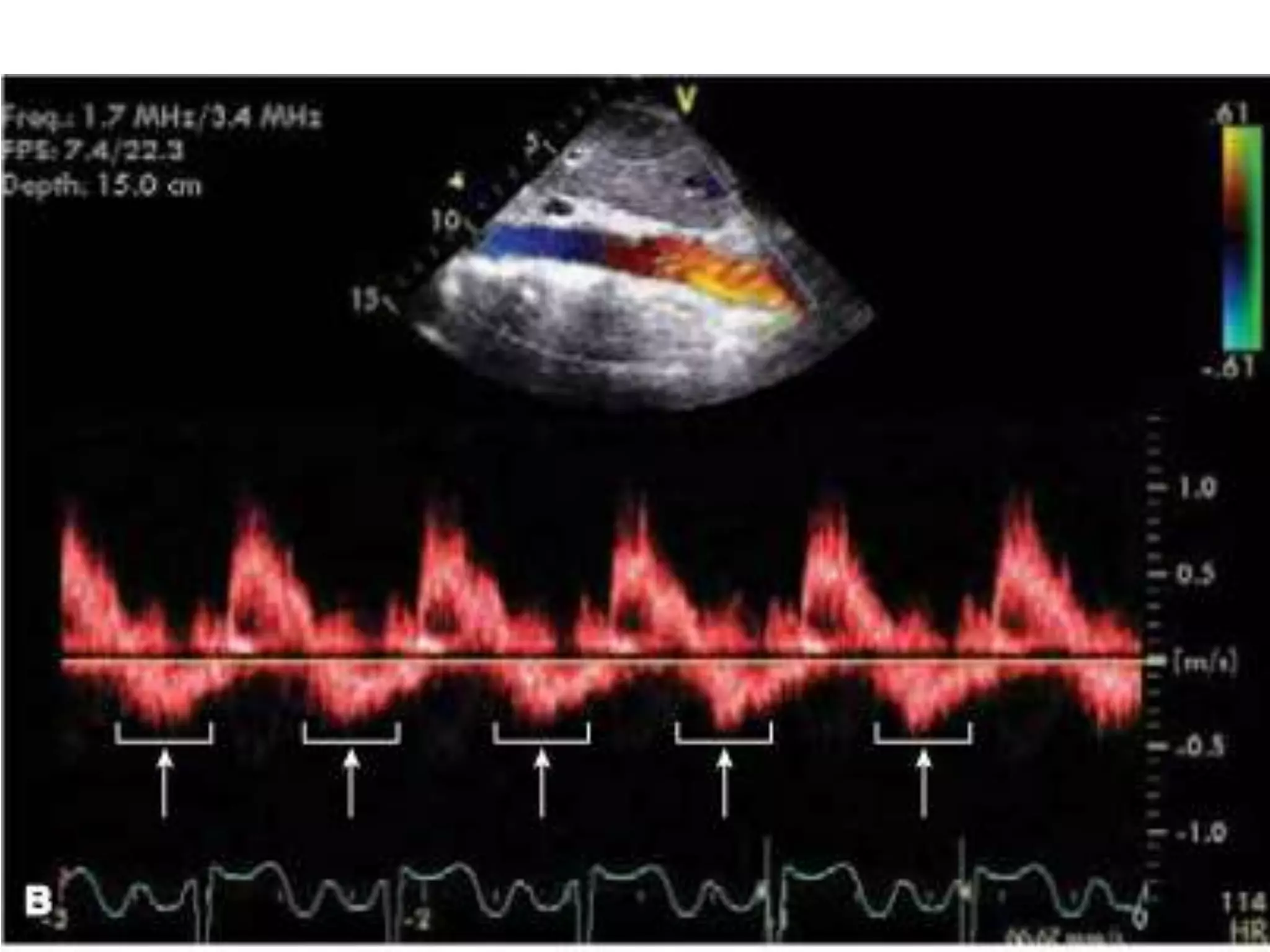 Echo assessment of Aortic Regurgitation | PPTX