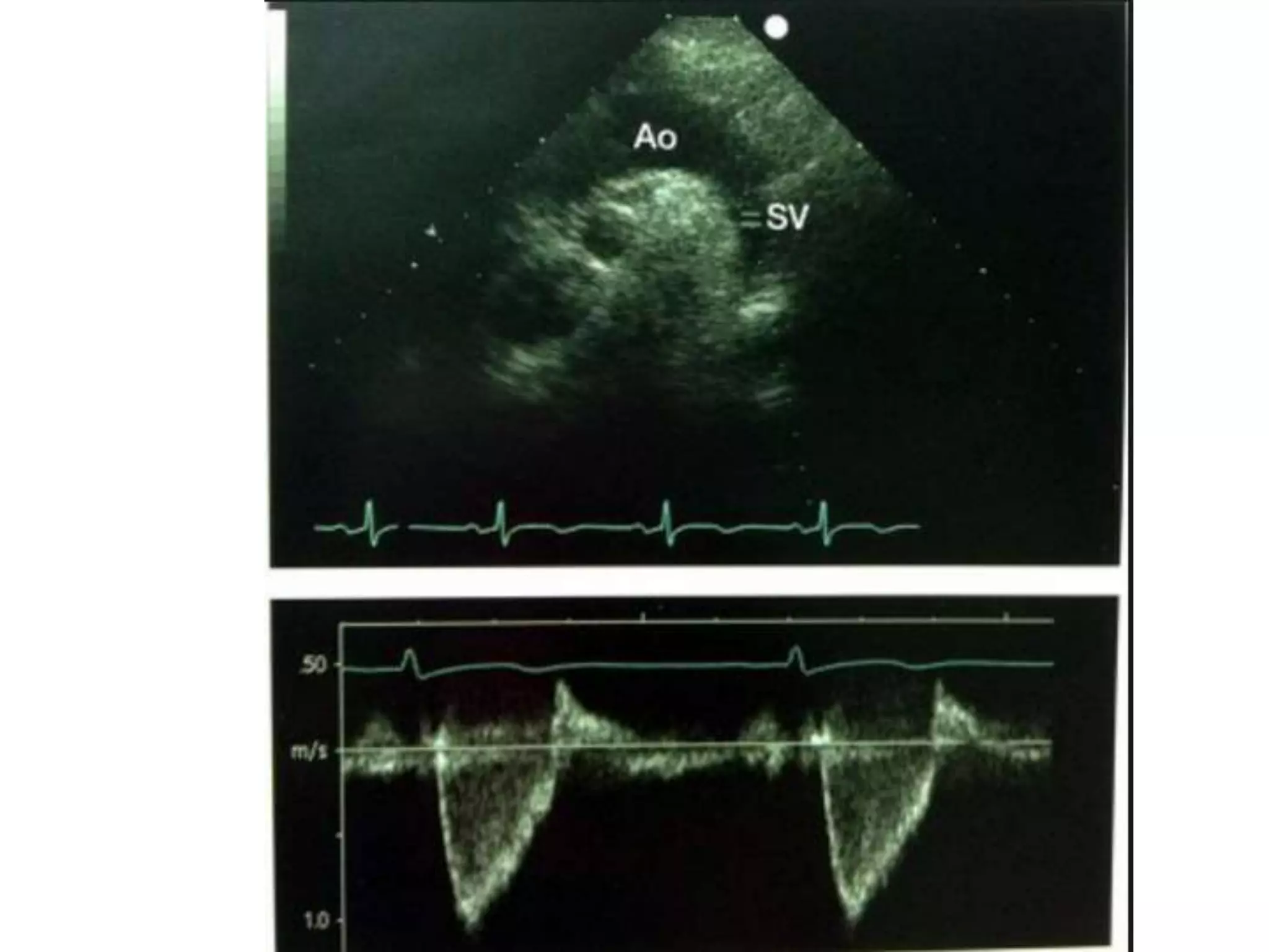 Echo assessment of Aortic Regurgitation | PPTX