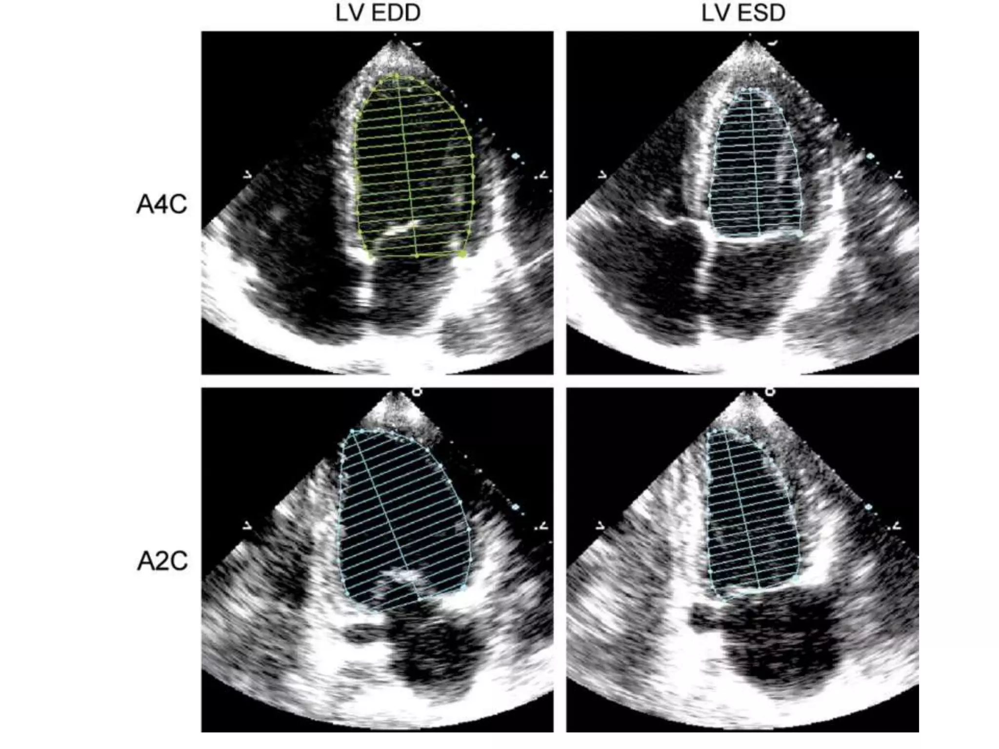 Echo assessment of Aortic Regurgitation | PPTX