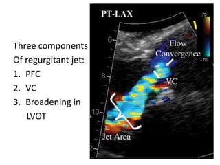 Echo assessment of Aortic Regurgitation | PPTX