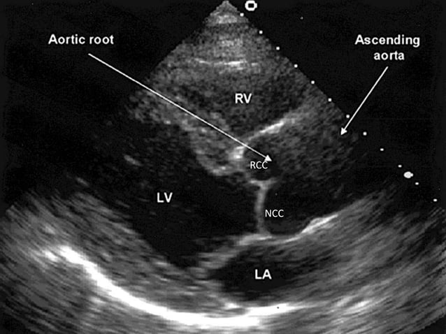 Echo assessment of Aortic Regurgitation | PPT