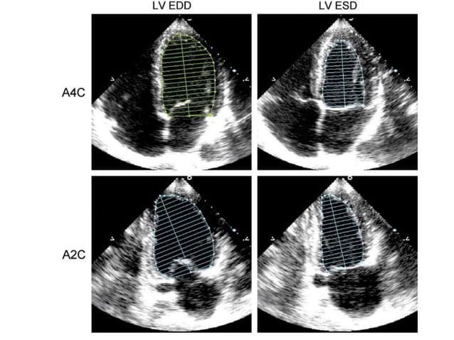 Echo assessment of Aortic Regurgitation | PPTX | Heart and ...