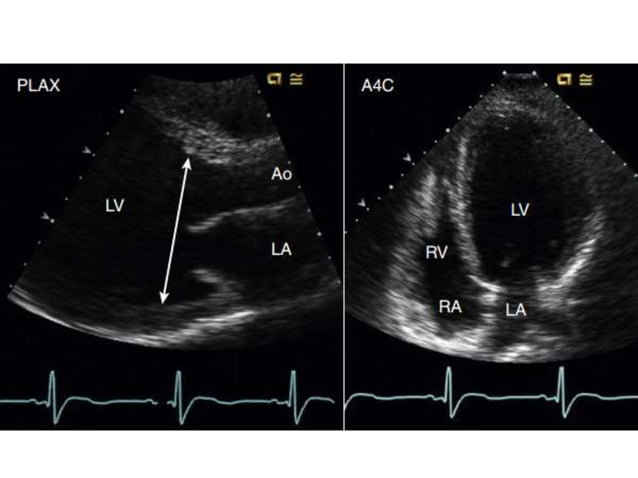 Echo assessment of Aortic Regurgitation | PPT