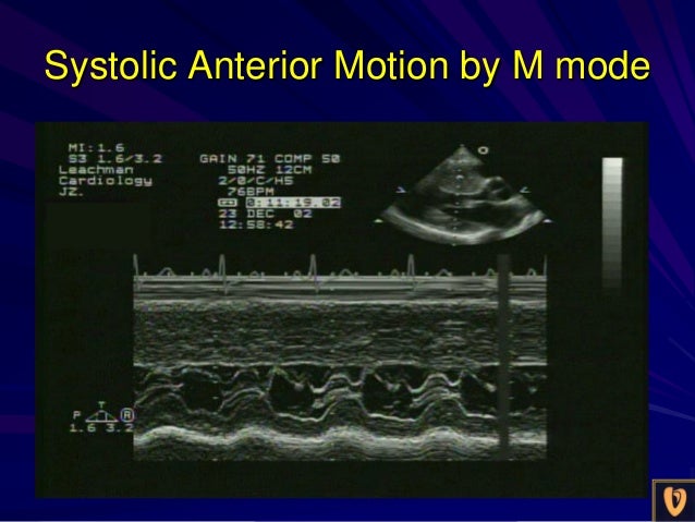 Echo assessment of cardiomyopathy pdf