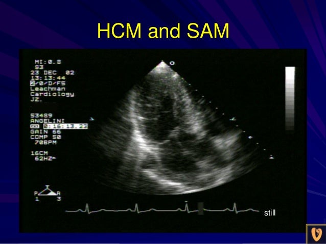 Echo assessment of cardiomyopathy pdf